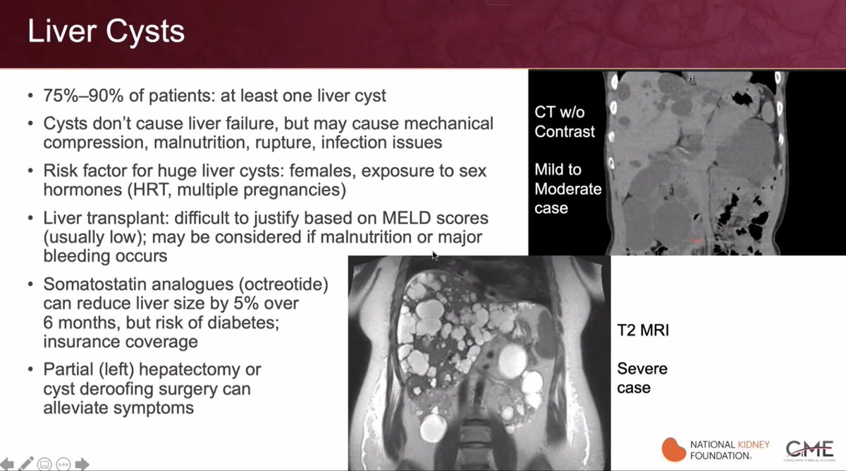 venglustat (GZ402671) / Sanofi